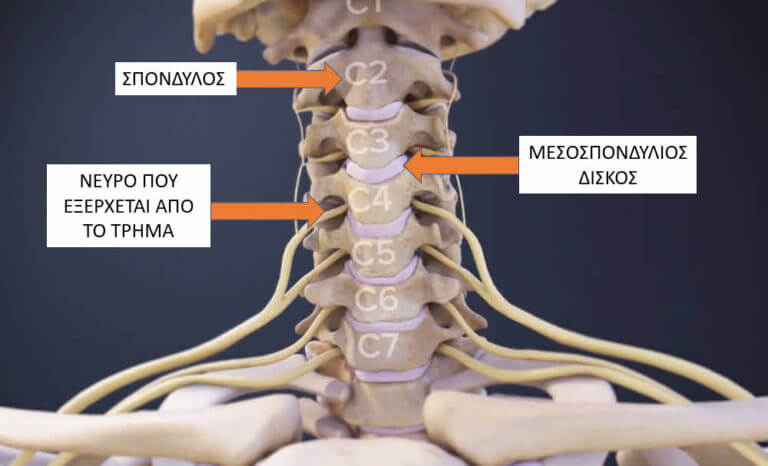 Κήλη στον Αυχένα | Dr. Χλωρός Γιώργος