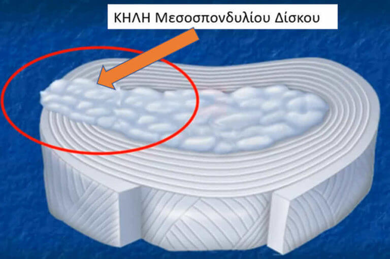 Κήλη στον Αυχένα | Dr. Χλωρός Γιώργος