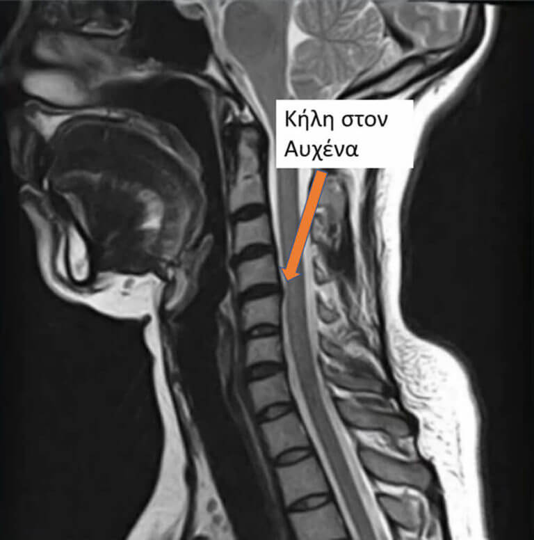 Κήλη στον Αυχένα | Dr. Χλωρός Γιώργος