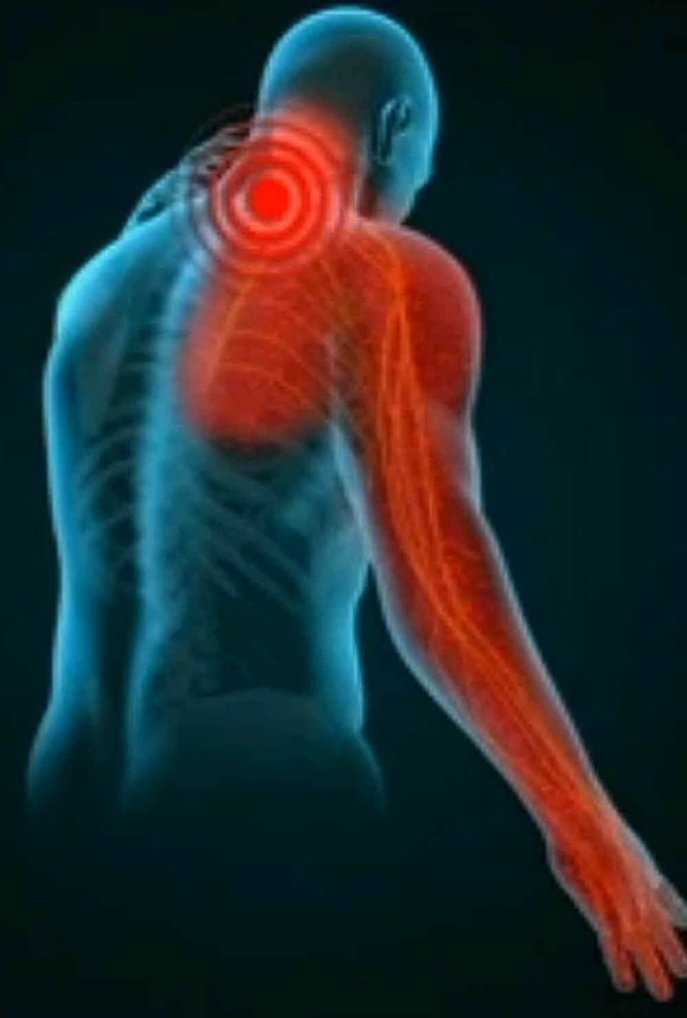 Κήλη στον Αυχένα | Dr. Χλωρός Γιώργος