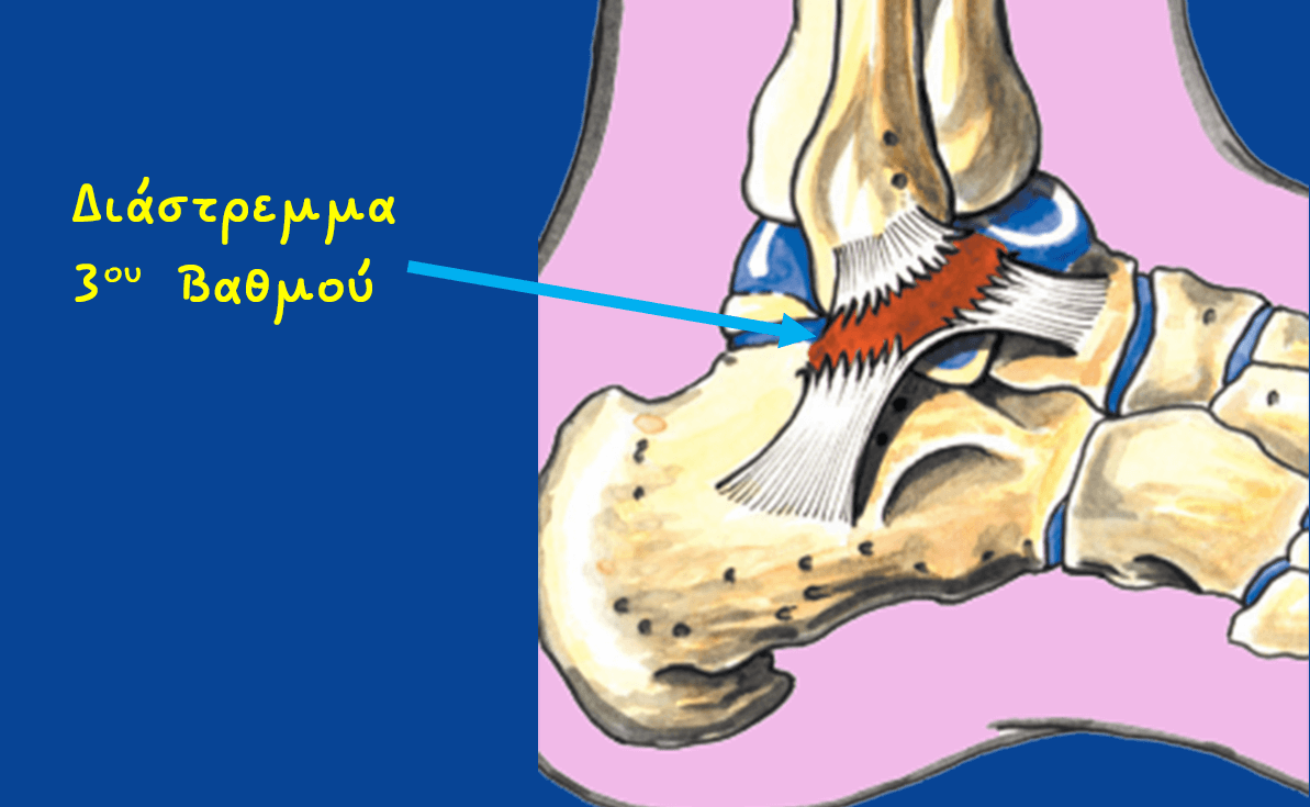 Στραμπούληγμα στον Αστράγαλο | Dr. Χλωρός Γιώργος