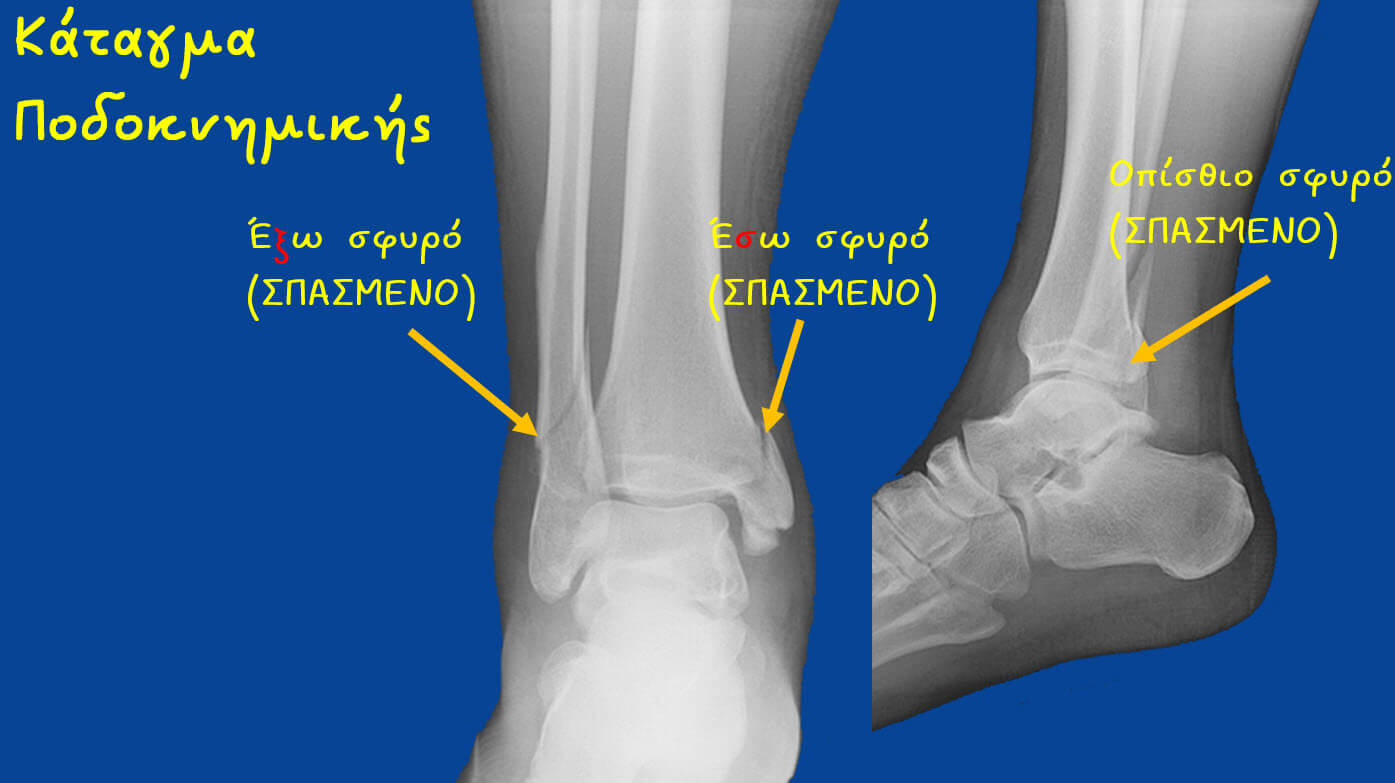 Κάταγμα αστραγάλου | Dr. Χλωρός Γιώργος