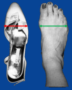 Κότσι στο πόδι (Βλαισός Μέγας Δάκτυλος) | Dr. Χλωρός Γιώργος