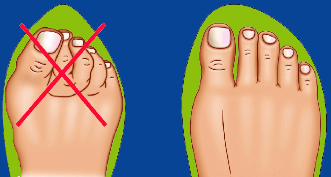 Κότσι στο πόδι (Βλαισός Μέγας Δάκτυλος) | Dr. Χλωρός Γιώργος