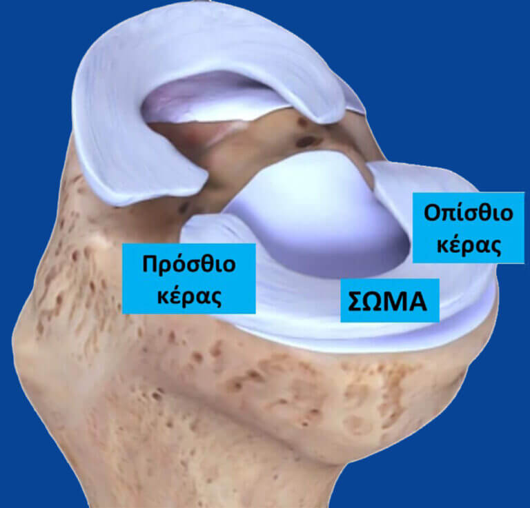 Ρήξη Μηνίσκου: Συμπτώματα - Αντιμετώπιση - Χειρουργείο