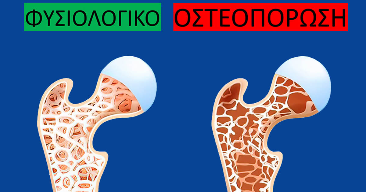 Οστεοπόρωση - Γεώργιος Δ. Χλωρός