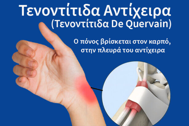 Τενοντίτιδα Αντίχειρα, ή Τενοντίτιδα De Quervain (ντε κερβέν) | Dr ...